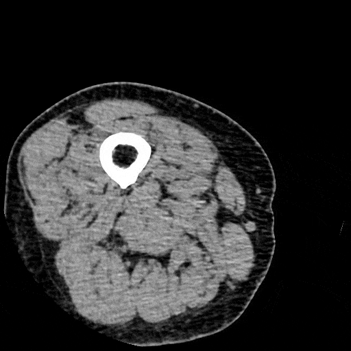 Metal Artifact Reduction – 3D and Quantitative Imaging Laboratory