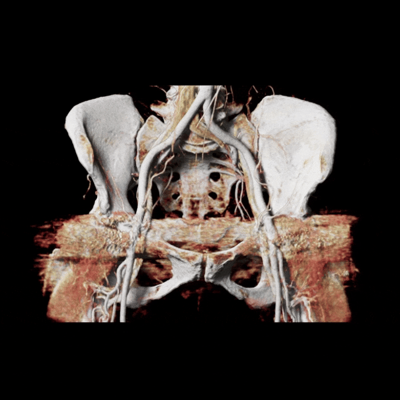 Metal Artifact Reduction – 3D and Quantitative Imaging Laboratory