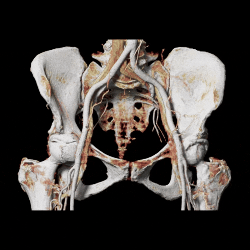 Metal Artifact Reduction – 3D and Quantitative Imaging Laboratory
