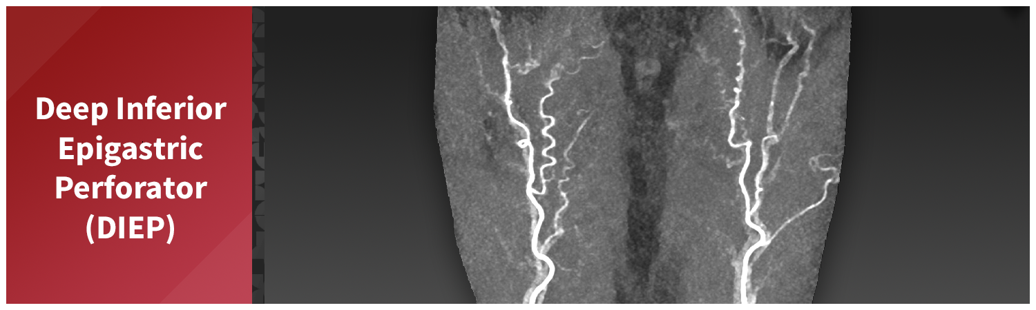 DIEP (Deep Inferior Epigastric Perforator) Flap Reconstruction – 3D and Quantitative Imaging ...
