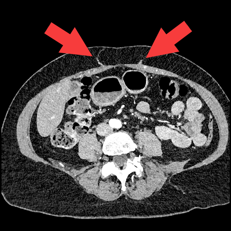 DIEP (Deep Inferior Epigastric Perforator) Flap Reconstruction – 3D and ...