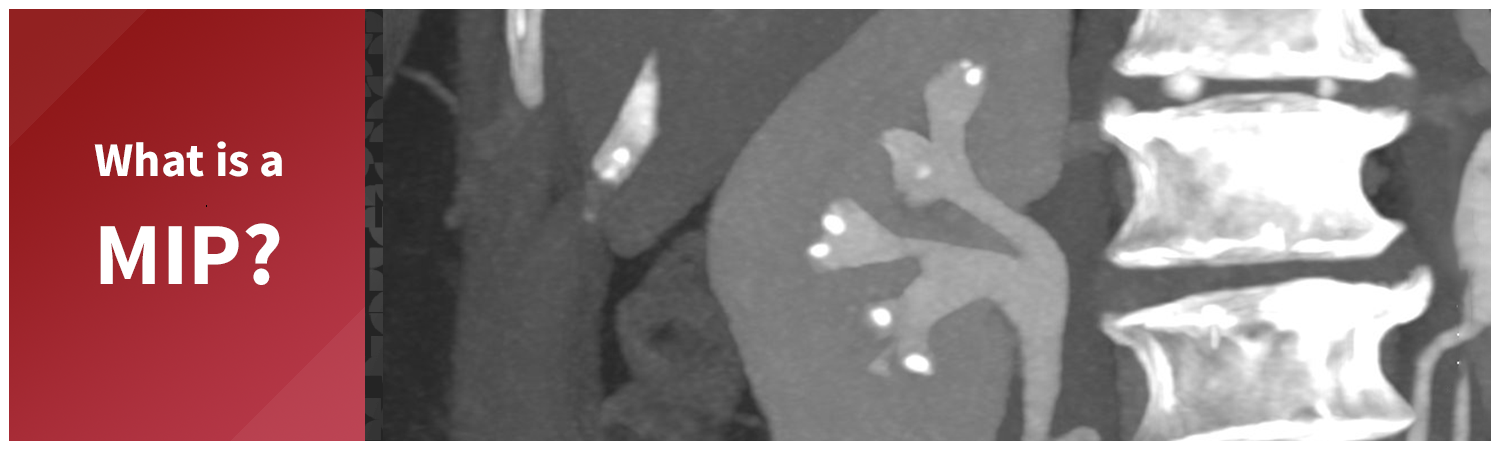 What is a MIP? – 3D and Quantitative Imaging Laboratory