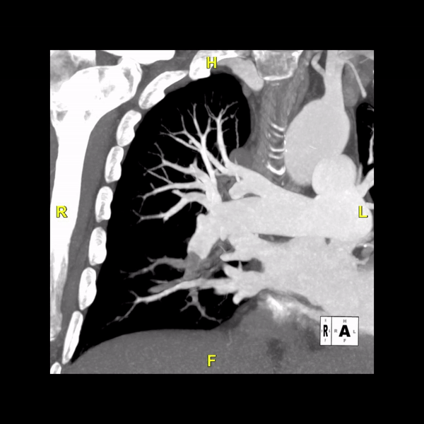 What is a MIP? – 3D and Quantitative Imaging Laboratory
