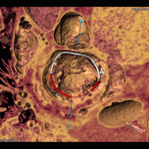 Transcatheter Mitral Valve Repair – 3D and Quantitative Imaging Laboratory