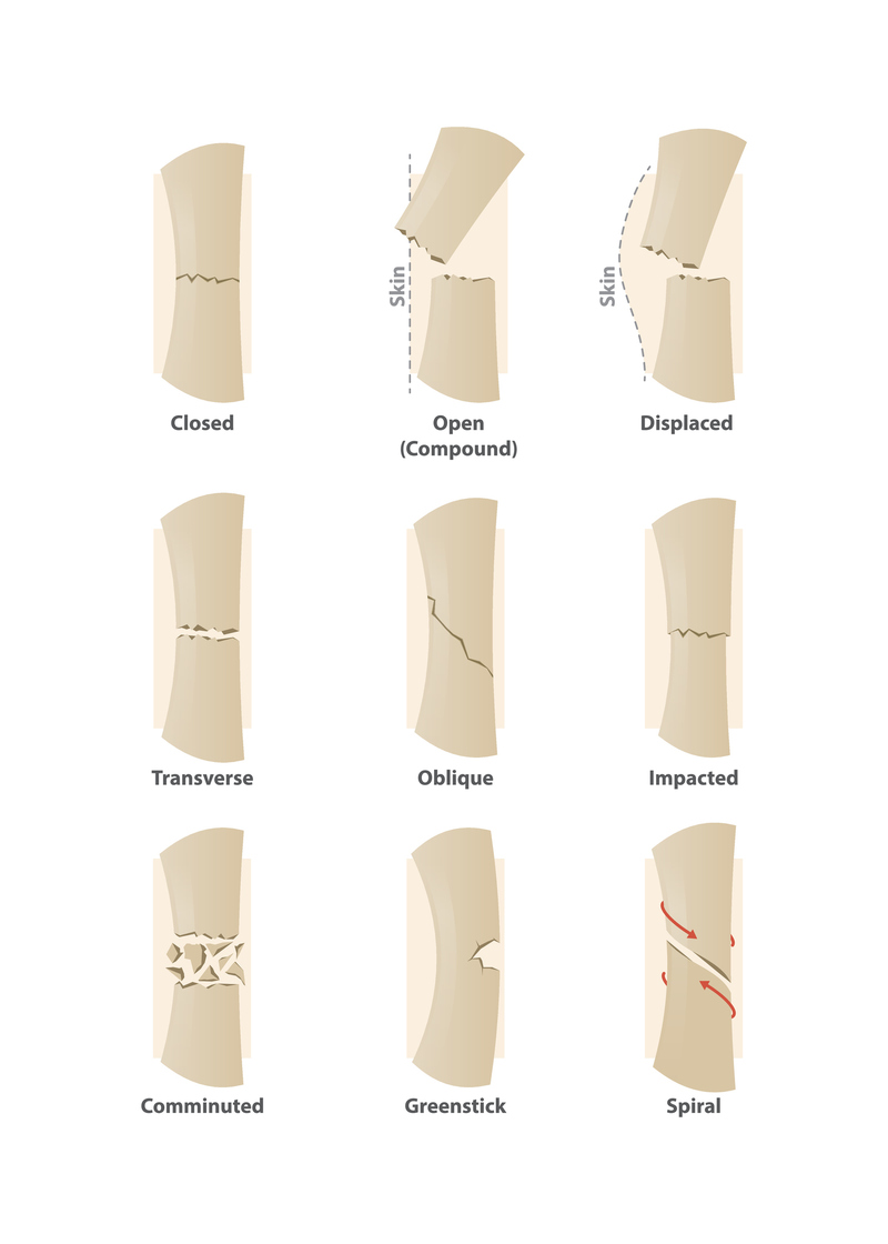 EMT Considerations in Orthopedic Trauma | MedicTests