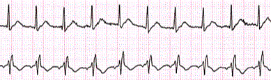 Bundle Branch Blocks - Right & Left, Complete vs Incomplete | MedicTests